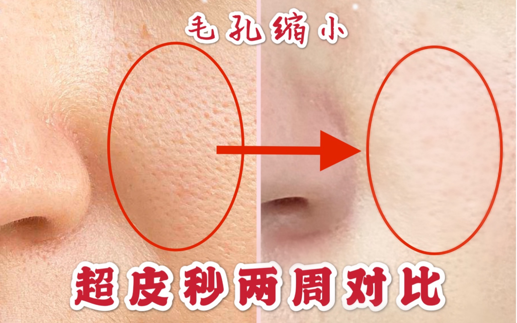 【Lily】超皮秒和蜂巢皮秒的两周后对比——收缩毛孔,哪个效果更好?