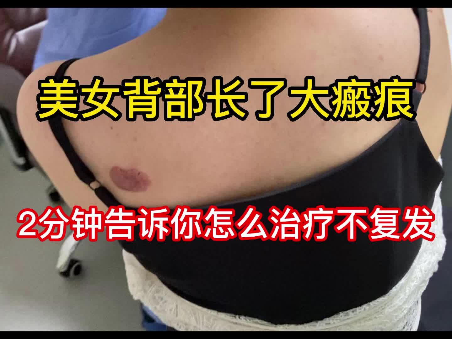 背部长了大的疤痕,2分钟告诉你怎么治疗才不会复发