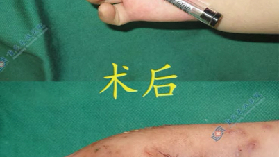 ...诊断先天性右桡骨缺如(IV型),经右腕关节矫形外固定支架术可如常生活