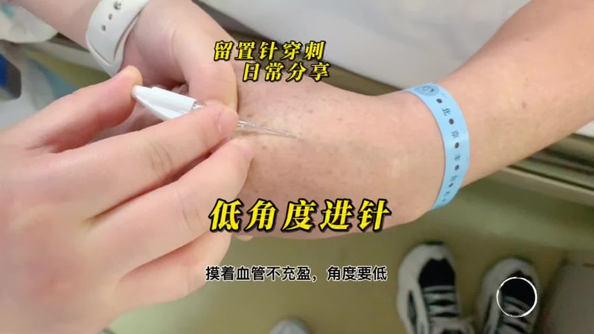 留置针穿刺日常分享…低角度进针#护士 #留置针