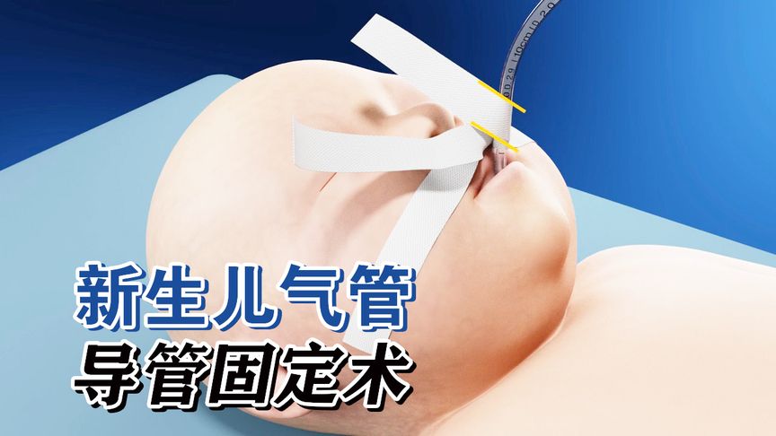 3D动画:新生儿气管导管固定术,有效防止气管导管滑脱