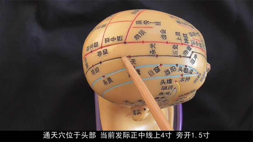 通天穴主治疾病:头痛,眩晕,头重,鼻疮,鼻塞,鼻渊等