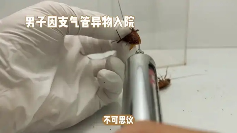 男子因支气管异物入院