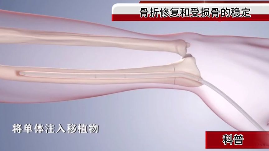 骨折修复的过程需要多久?骨受伤的稳定恢复原理?