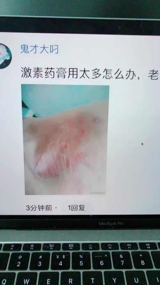 大腿根长期使用激素乳膏导致皮肤断裂,形成萎缩纹