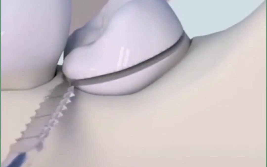 【拔智齿】这颗智齿可不是硬拔的,这样的拔法一点也不痛!