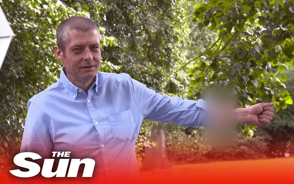 英国一老哥患病导致钉钉脱落,医生在他手臂上种了个新的…