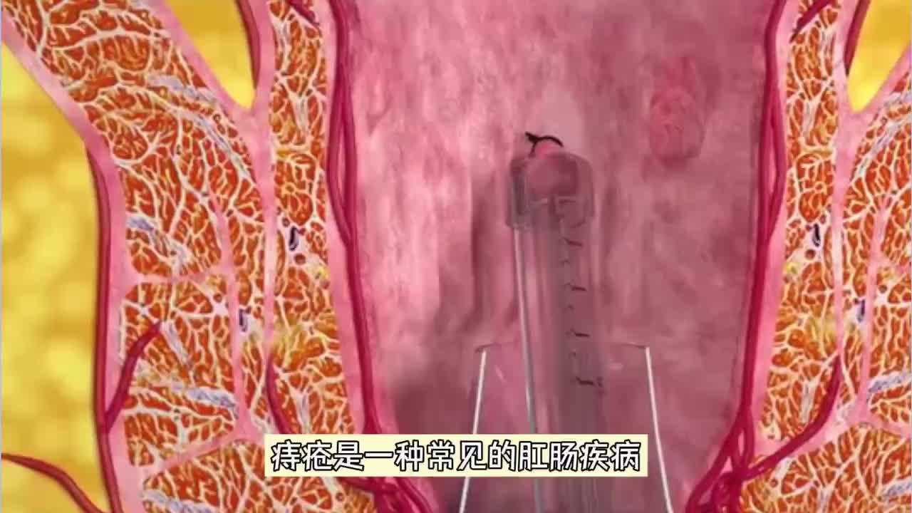 痔疮出血但是不疼怎么回事?