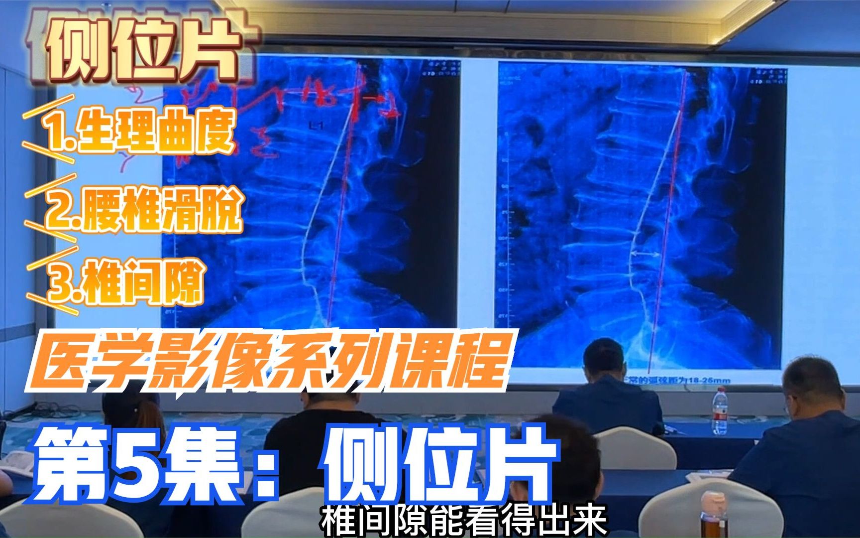 经典,6分钟详解医学影像腰部侧位片5个关键功能,如诊断腰椎滑脱