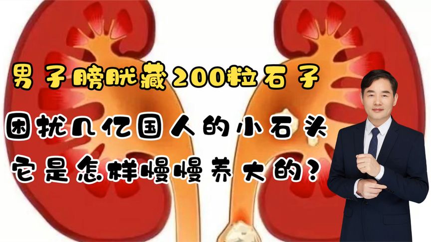 男子膀胱藏着200颗石子,尿道结石是怎样形成的,告诉你解决办法