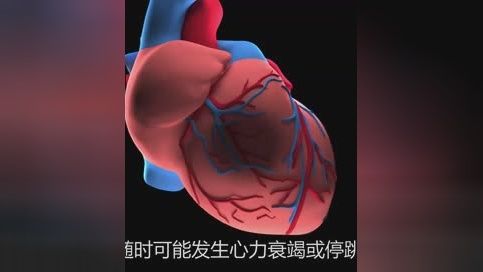 科普心梗,让更多人受益:PCI心肌梗死治疗介入
