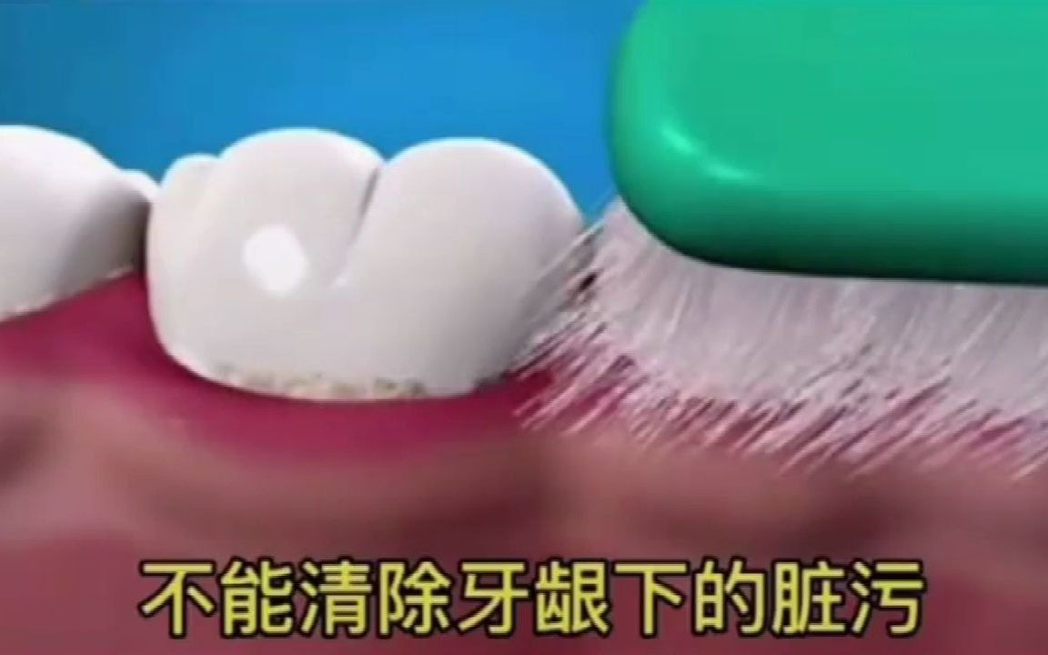 龈下刮治有必要吗?非常有必要!