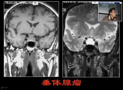 鞍区解剖及病变的ct,MRI