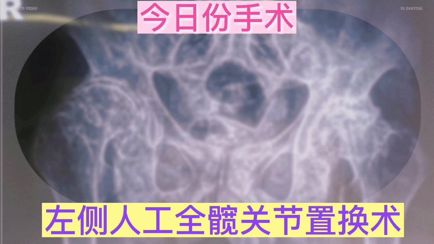 今日份手术:患者强直性脊柱炎,双侧髋关节无菌性坏死