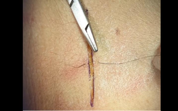 持针器打结技巧