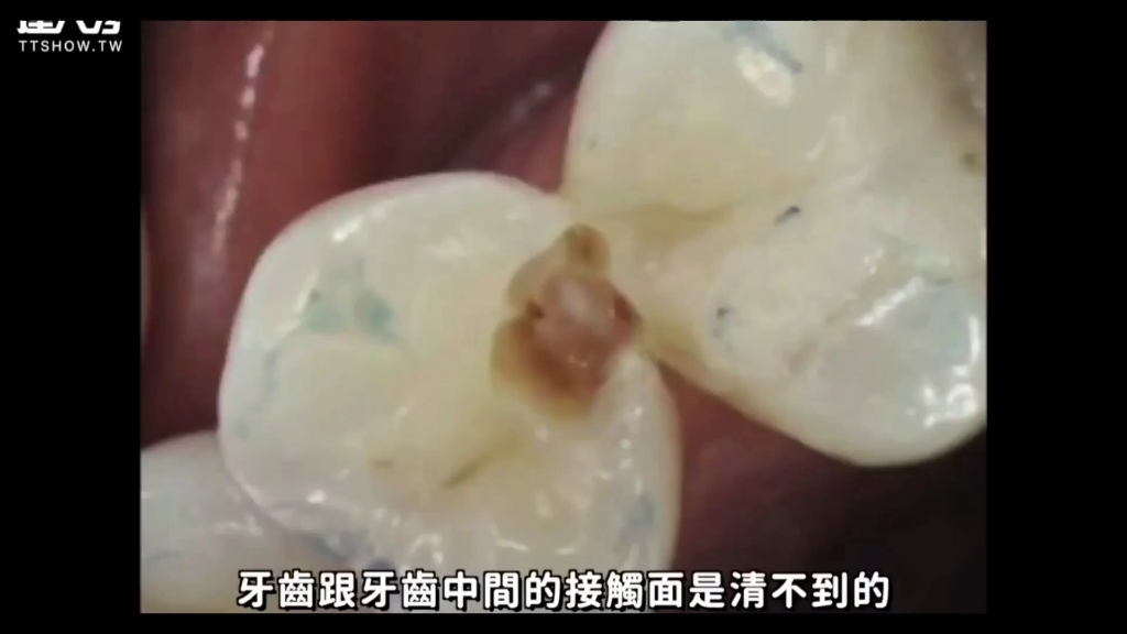 你会不会用牙线呢?牙结石怎么还这么多?教你日常生活怎么正确使用...