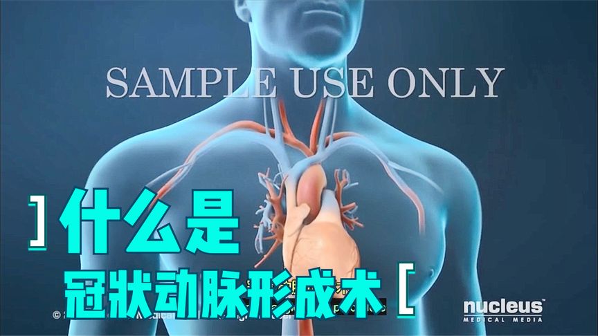 什么是冠状动脉形成术,动画解析