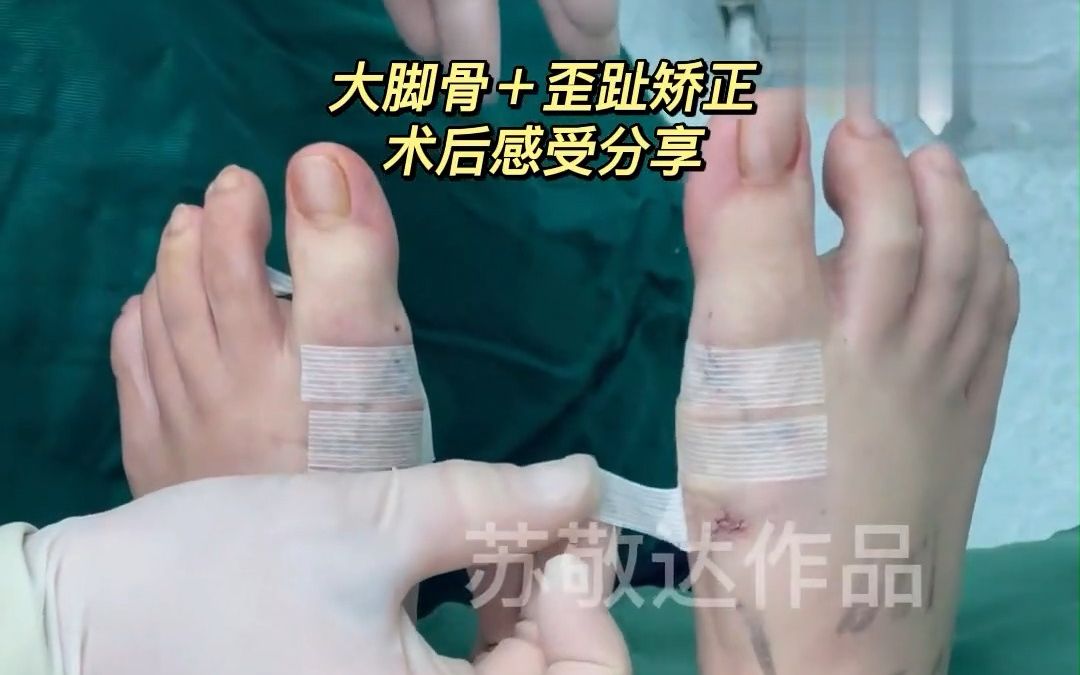 【苏敬达】28岁姑娘拇外翻手术感受:太神奇了!没想到做完就能活动!