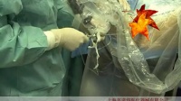 上海英诺威封堵取石器输尿管钬激光碎石手术教程