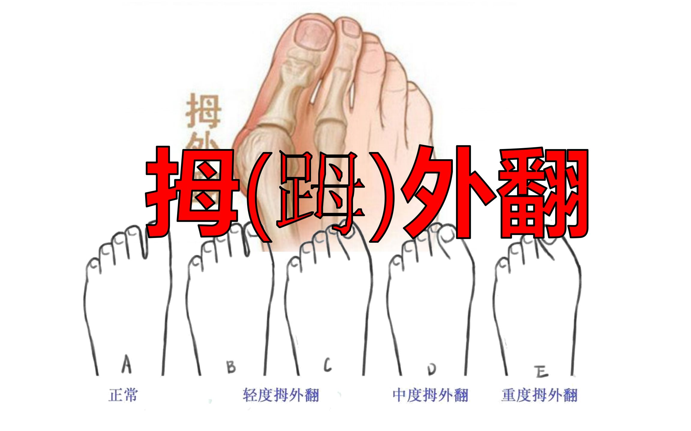 拇外翻的形成原因与处理思路