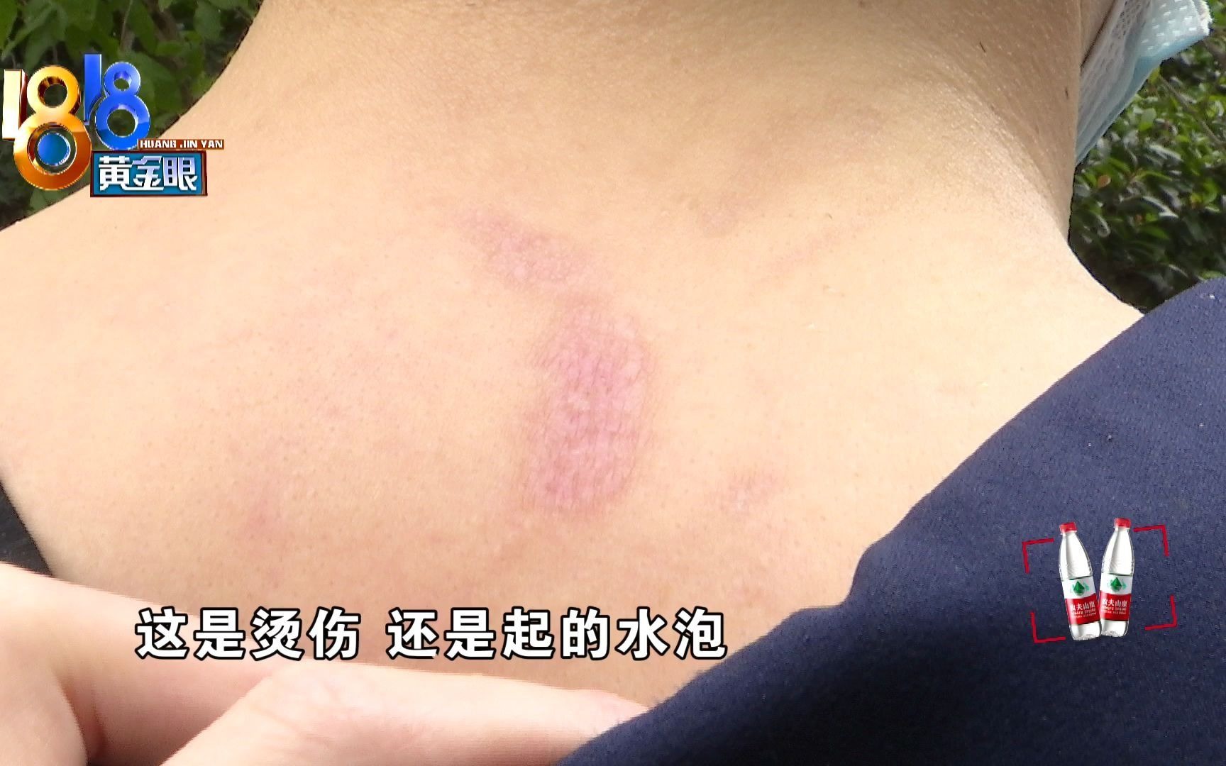 “顶尚”做护理,擀筋棒戳伤,拔火罐烫伤?