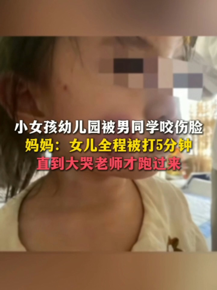 小女孩幼儿园被男同学咬伤脸